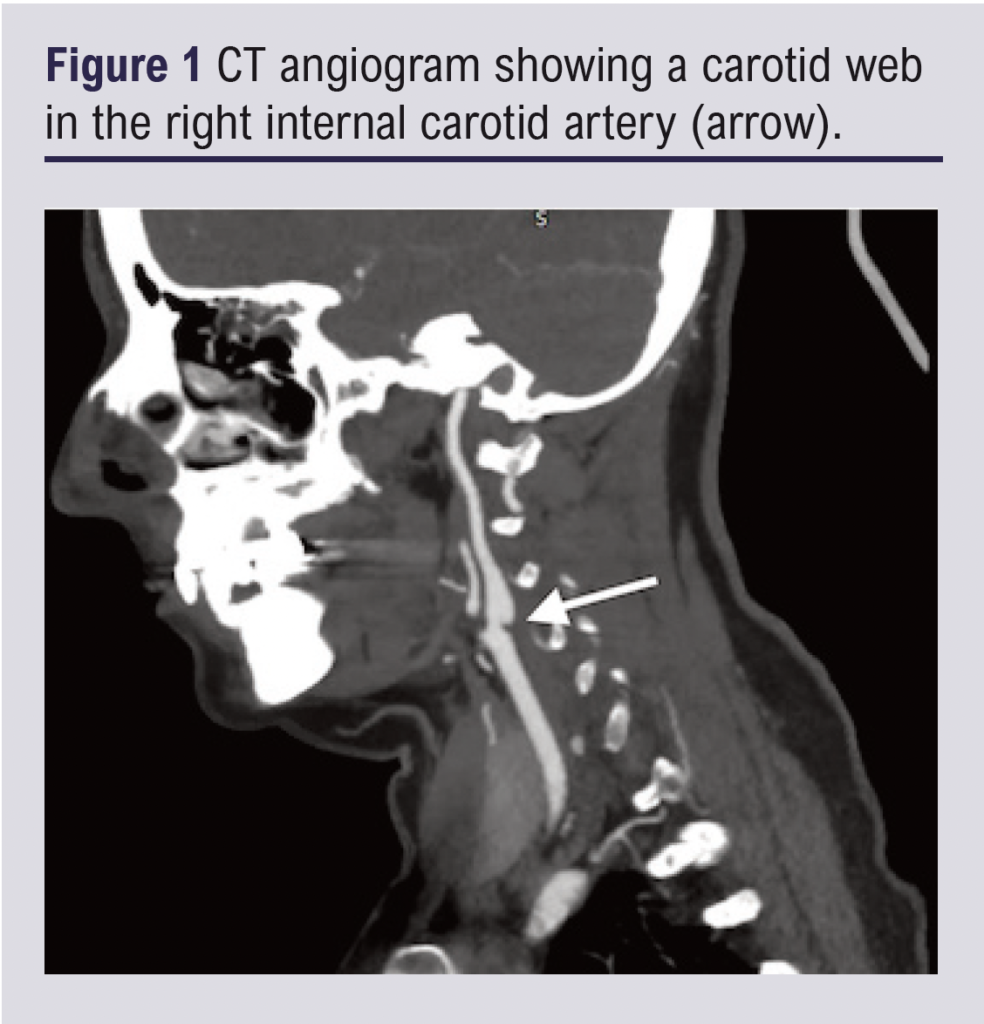 Carotid web: an important cause of stroke in young people – Journal of ...