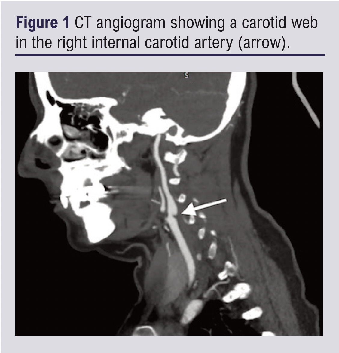 Carotid web: an important cause of stroke in young people – Journal of Vascular Societies Great ...