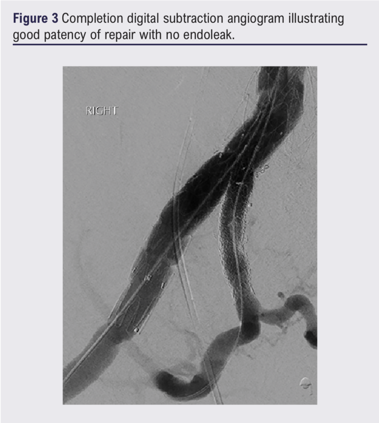 Use of a Heli-FX System Guide steerable sheath for internal iliac ...