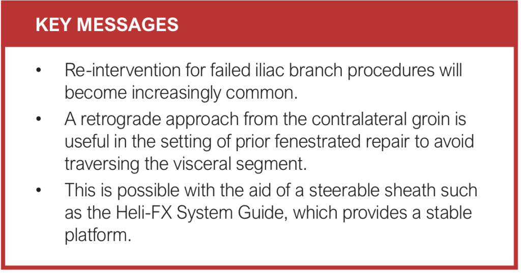 Use of a Heli-FX System Guide steerable sheath for internal iliac ...