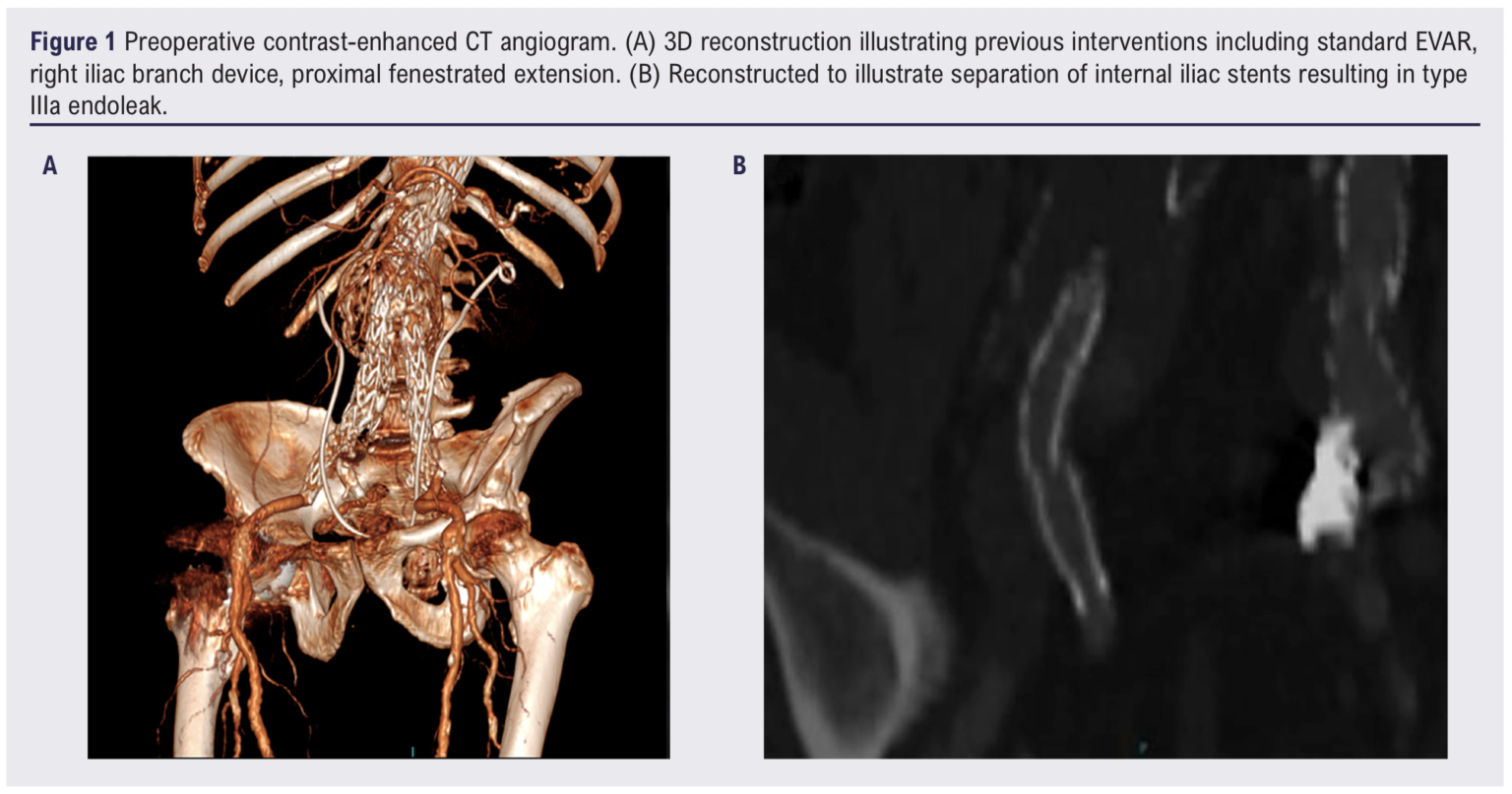 Use of a Heli-FX System Guide steerable sheath for internal iliac ...