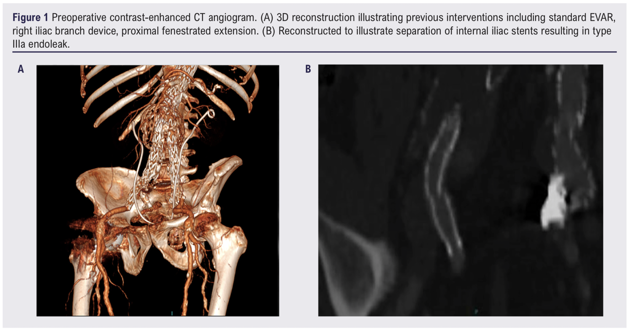 Use of a Heli-FX System Guide steerable sheath for internal iliac ...