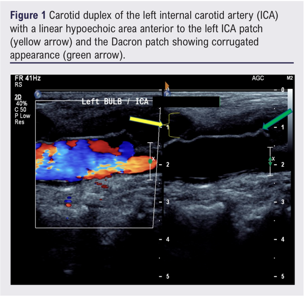 Carotid EndoVAC: a novel hybrid technique for carotid Dacron patch ...
