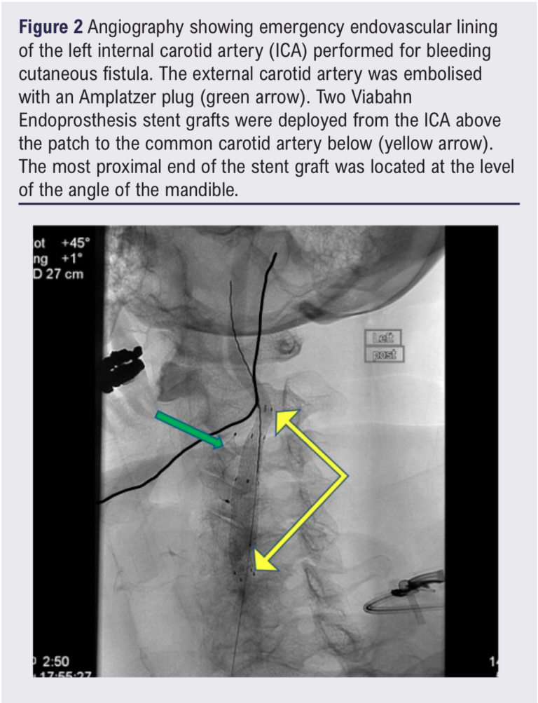 Carotid EndoVAC: a novel hybrid technique for carotid Dacron patch ...