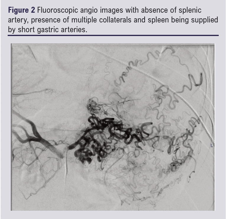 Congenital absence of splenic artery: a rare cause of upper ...