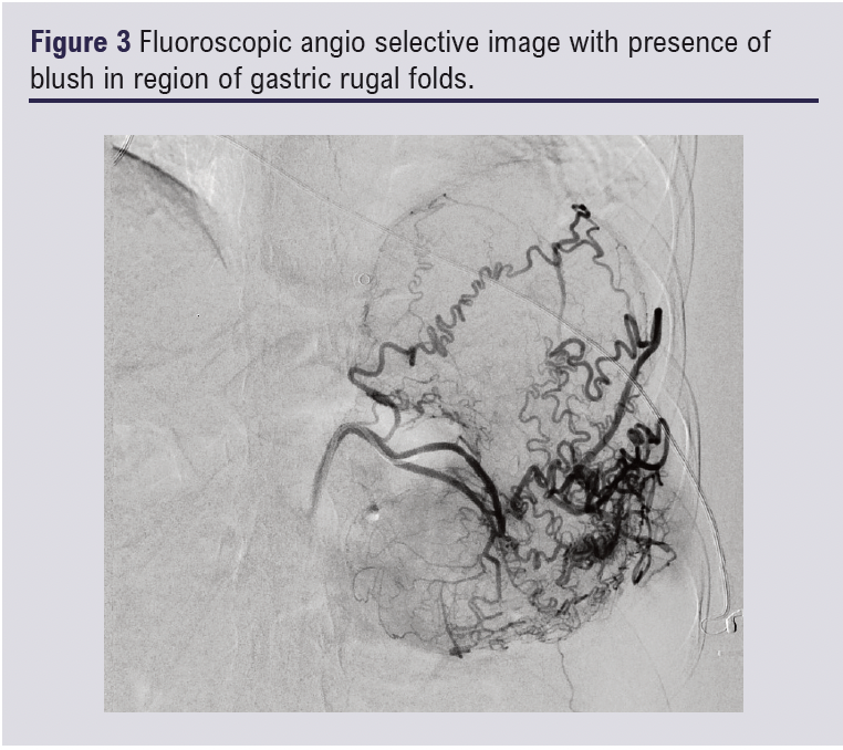 Congenital absence of splenic artery: a rare cause of upper ...