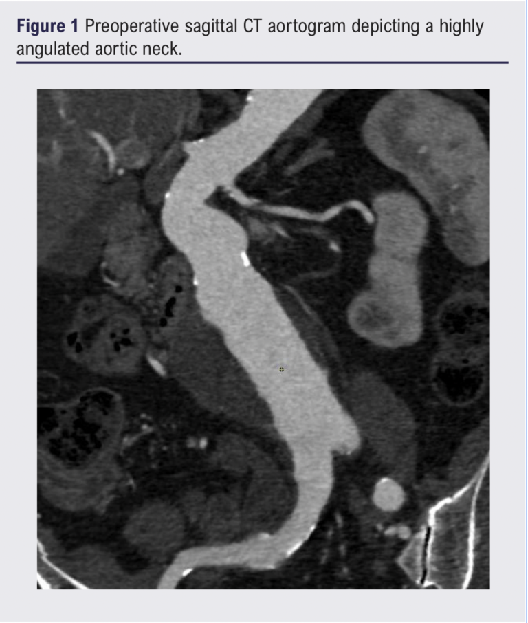 Endovascular aneurysm repair using the Gore Excluder Conformable ...