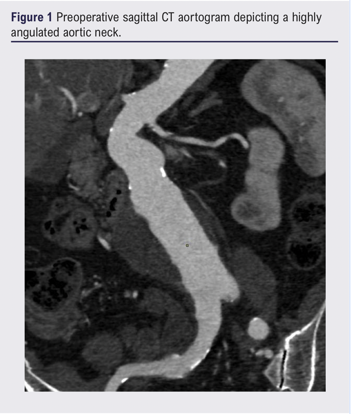 Endovascular aneurysm repair using the Gore Excluder Conformable ...