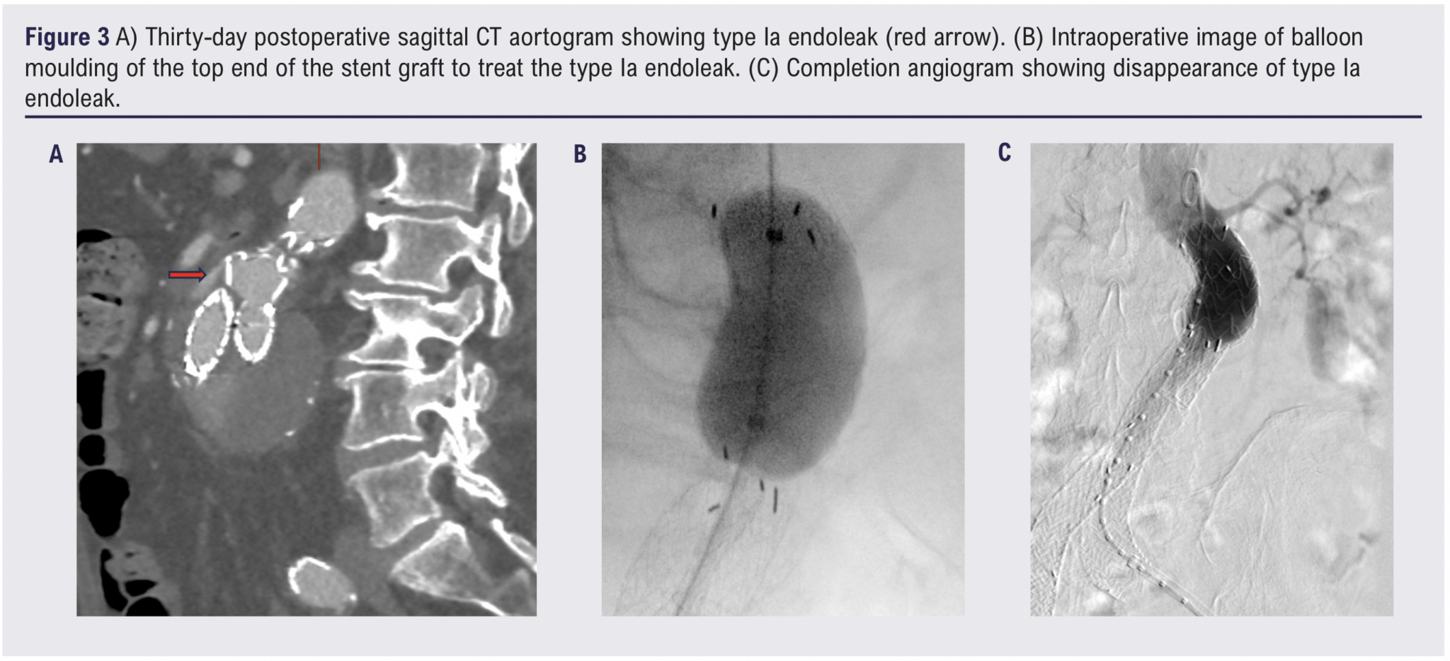 Endovascular aneurysm repair using the Gore Excluder Conformable ...