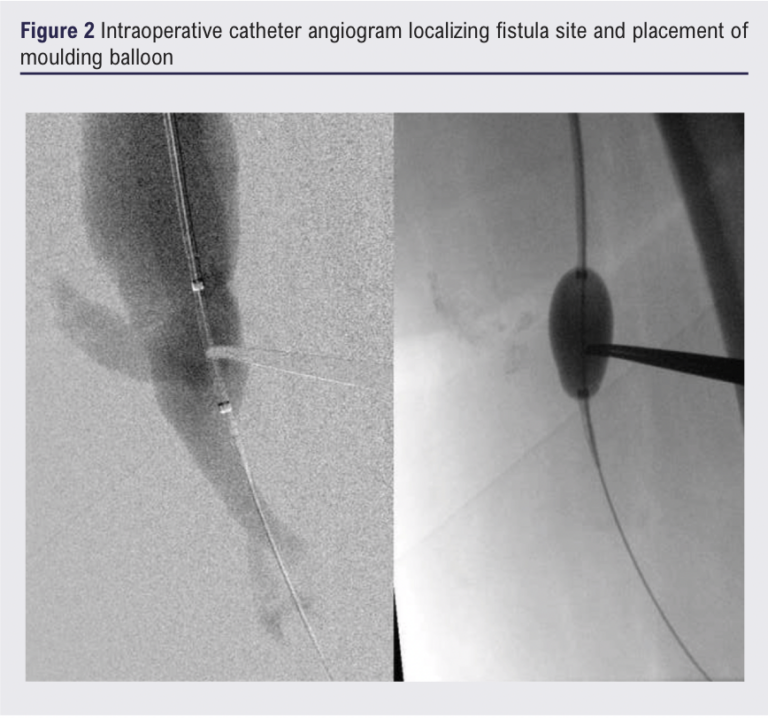 Traumatic thigh AV fistula leading to aneurysmal changes in aorta and ...