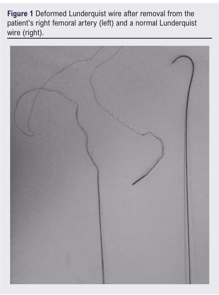 A deformed Lunderquist wire in a percutaneous endovascular aortic ...