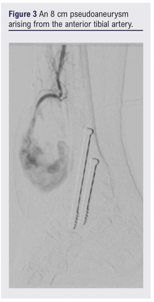 Pseudoaneurysm of the anterior tibial artery following arthrodesis on a ...