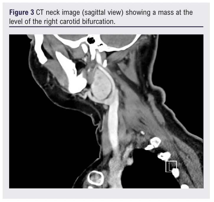 Ectopic thyroid tissue presenting as a carotid body paraganglioma ...