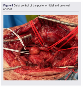 A rare case of true tibioperoneal trunk aneurysm resulting in foot drop ...