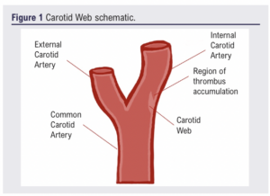 Carotid webs: a review of diagnosis and management strategies in ...