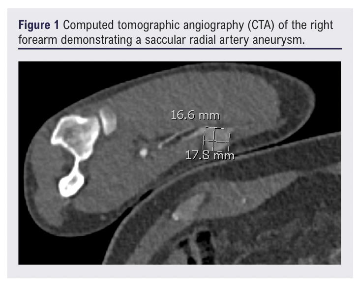 Surgical repair of a right proximal radial artery true aneurysm: case ...